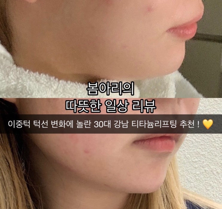 강남 티타늄리프팅 추천 이중턱이던 턱선 변화에 놀란 30대 티타늄리프팅후기💛 네이버 블로그