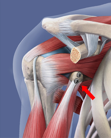 Shoulder-Open Latarjet procedure : 네이버 블로그