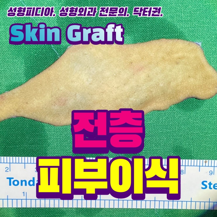 [피부이식] 전층 피부이식 수술 (FTSG, full thickness skin graft, 욕창치료 feat. 성형외과 전문의 ...