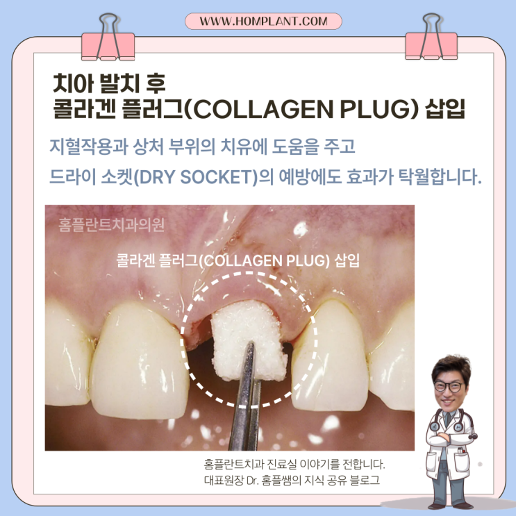 치아 발치 후 드라이 소켓(Dry Socket) 예방을 위한 '콜라겐 플러그(Collagen plug)'시술 : 네이버 블로그
