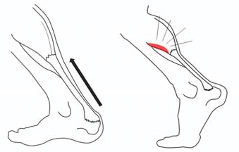 테니스 레그(tennis leg)의 진단과 치료 : 네이버 블로그