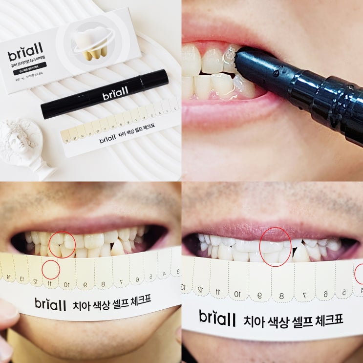 셀프치아미백 후기 브리올 퓨어 프리미엄 화이트닝 미백겔 네이버 블로그