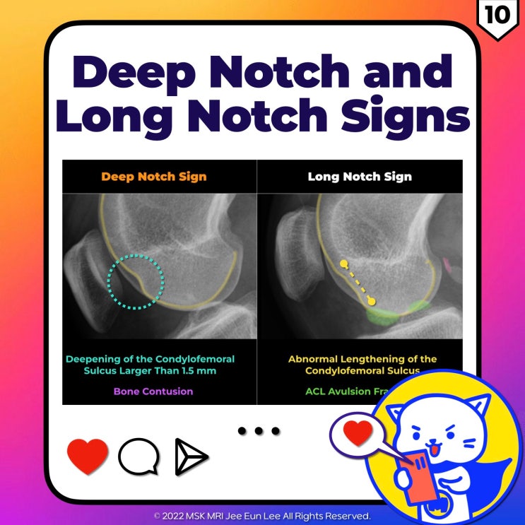 (Fig 2-B.10) Deep notch and Long notch signs : 네이버 블로그