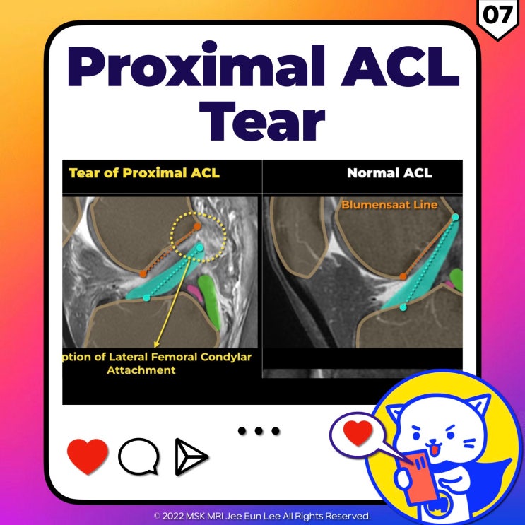 (Fig 2-B.07) Proximal ACL tear : 네이버 블로그