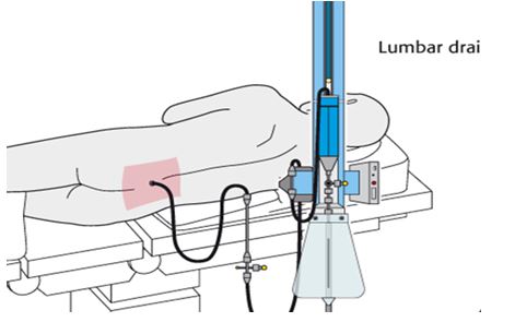 의학용어 Lumbar drainage :: 요추배액술 정의 목적 관리 주의사항 : 네이버 블로그