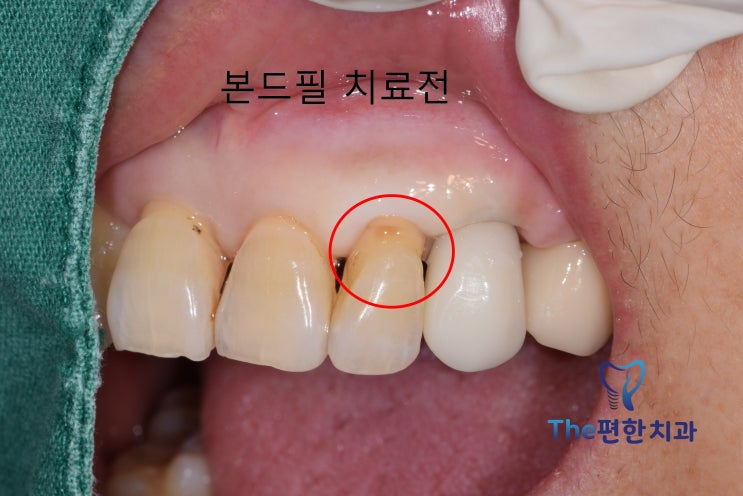 잇몸패임 치경부마모 치아시림 네이버 블로그