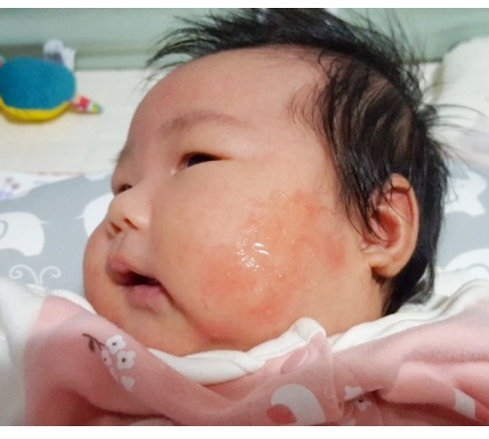 신생아 태열 수딩젤 추천 아기 얼굴 태열 네이버 블로그