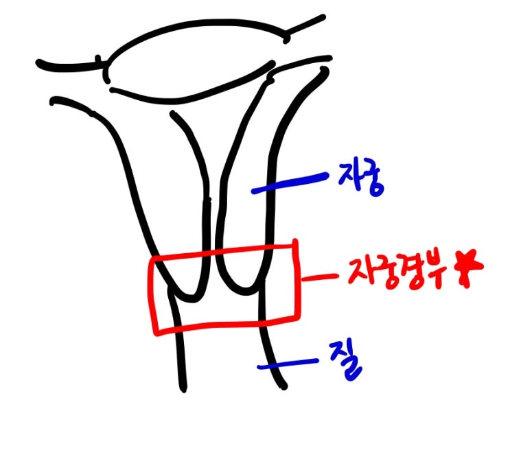[여성건강간호학] 자궁경관 무력증(Incompetent internal os of cervix) : 네이버 블로그