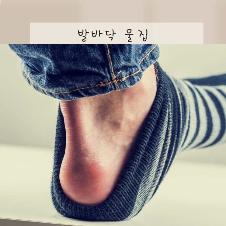 발바닥 물집 새끼 발가락 발에 물집 생겼을때 터뜨리기 원인 연고 대처방법 네이버 블로그