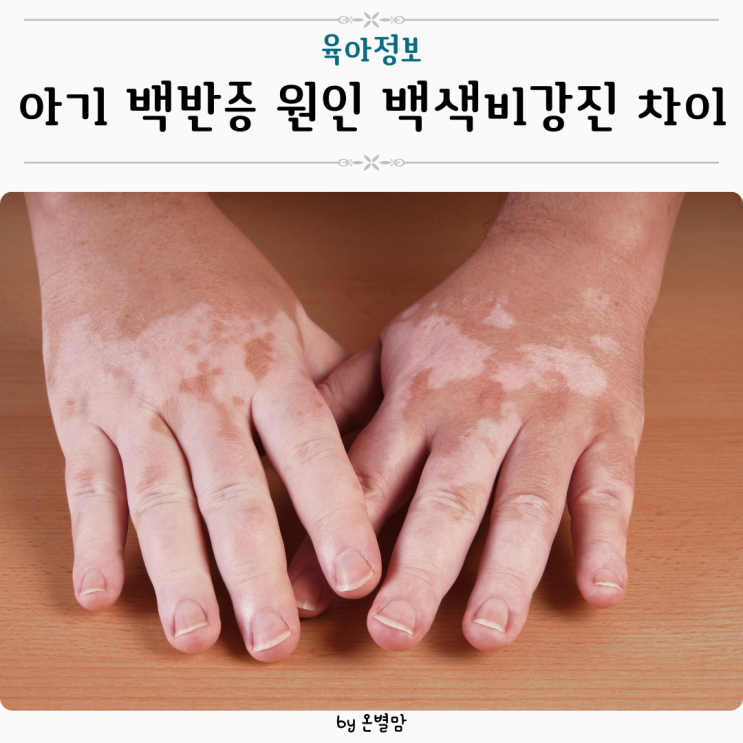 아기 백반증 원인 치료 백색비강진 이소성몽고반점 차이 네이버 블로그