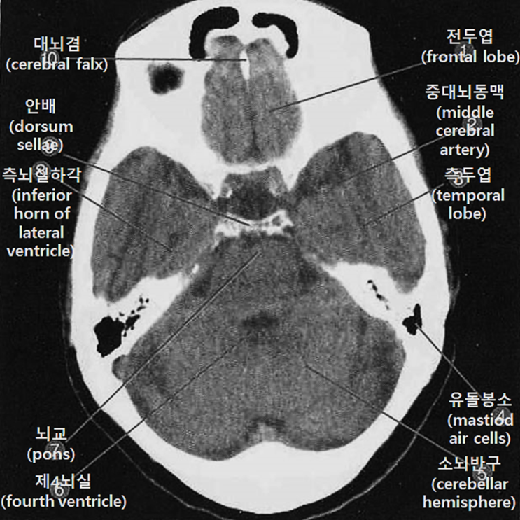 Brain_CT image_29: 교경색(pontine infraction) : 네이버 블로그
