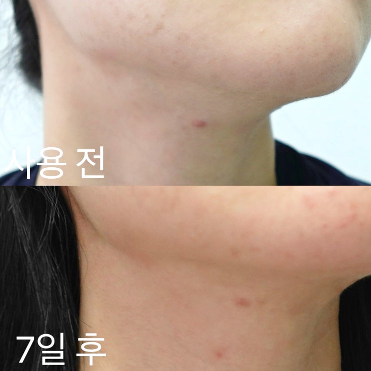 좁쌀 여드름 앰플 임피엘 시카 비건 아크네 클리어 앰플 7일 사용 후기 네이버 블로그