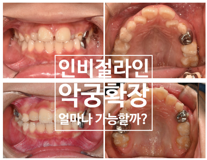 악궁확장 효과어린이 인비절라인 Vs 악궁확장장치 논문과 실제 증례 성장기의 위대함이란 네이버 블로그