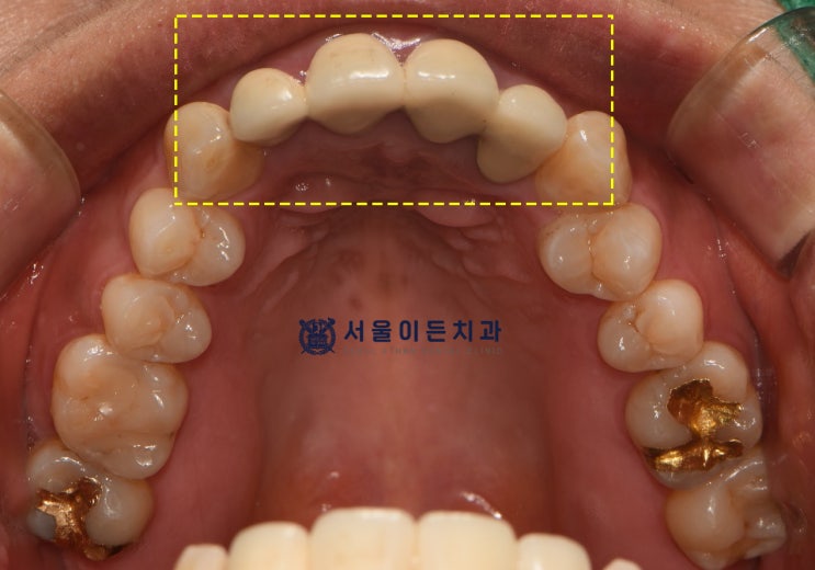 불광동 치과 잇몸 통증 염증 브릿지 제거 후 발치 앞니 임플란트 네비게이션 활용 사례 네이버 블로그