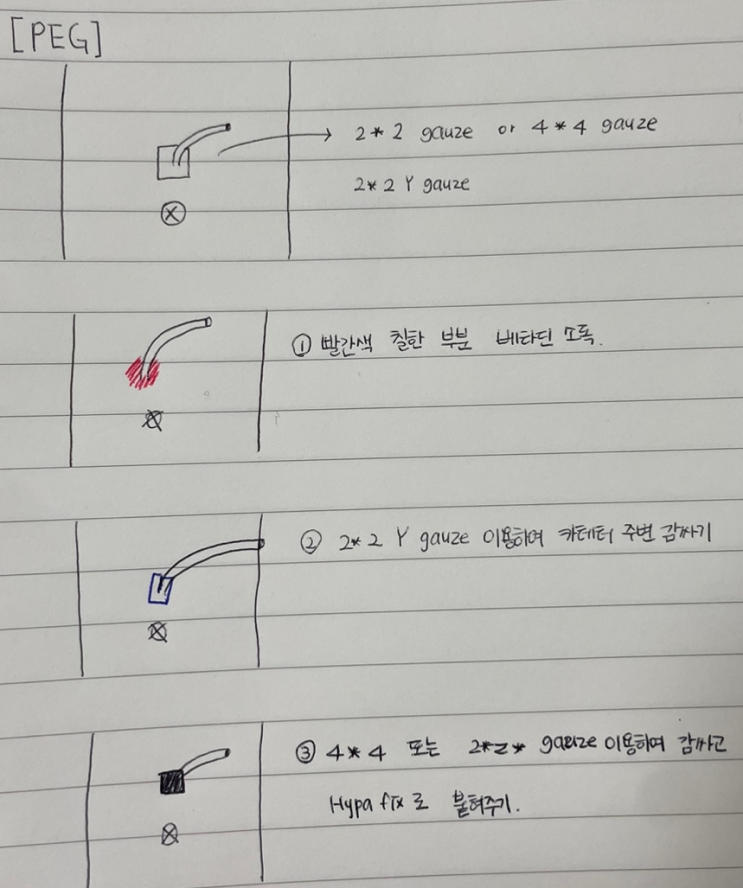 PEG(Percutaneous Endoscopic Gastrostomy, G-tube, 경피적 내시경하 위루술) : 네이버 블로그
