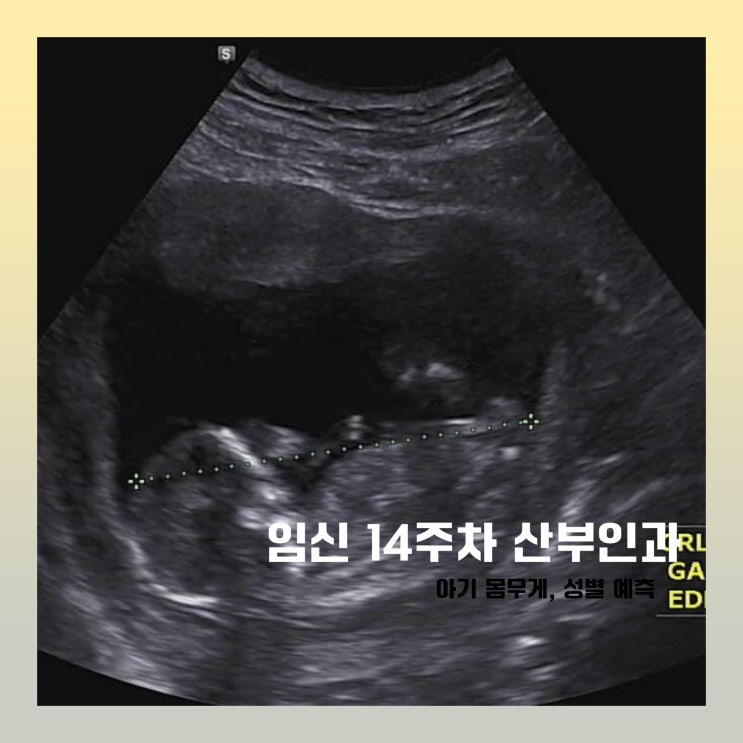 임신 13주 6일 영주 기독병원 성별확인 아기크기 입체초음파 장꾸맘 각도법 성별 추측 산부인과 진료 비용