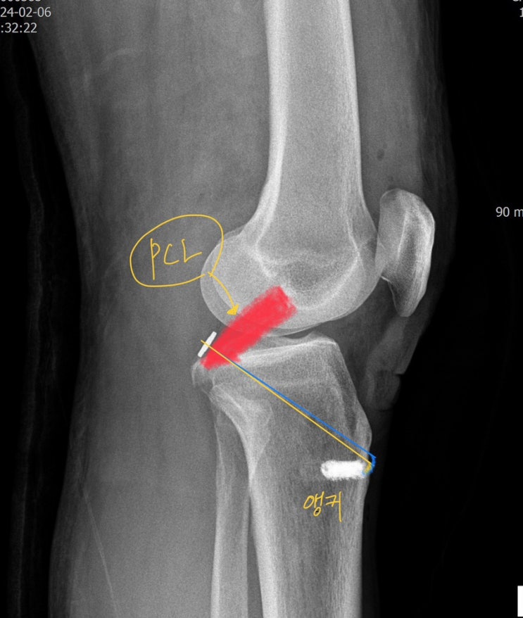 [후방십자인대 견열골절] (PCL avulsion fracture). 관절 내시경을 통한 고정술 : 네이버 블로그