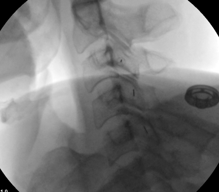 목 주사, 신경차단술 (Cervical MBB : 경추 후지 내측지 차단술) 의 합병증, 위험성 : 네이버 블로그