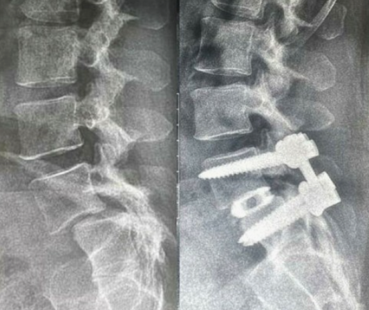 spine fusion, 척추유합술(TLIF/PLIF/수술준비물/수술과정/scrub) : 네이버 블로그