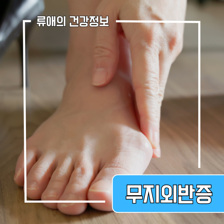 무지외반증 증상 및 원인 통증 무지외반증 수술 재발 관리 네이버 블로그