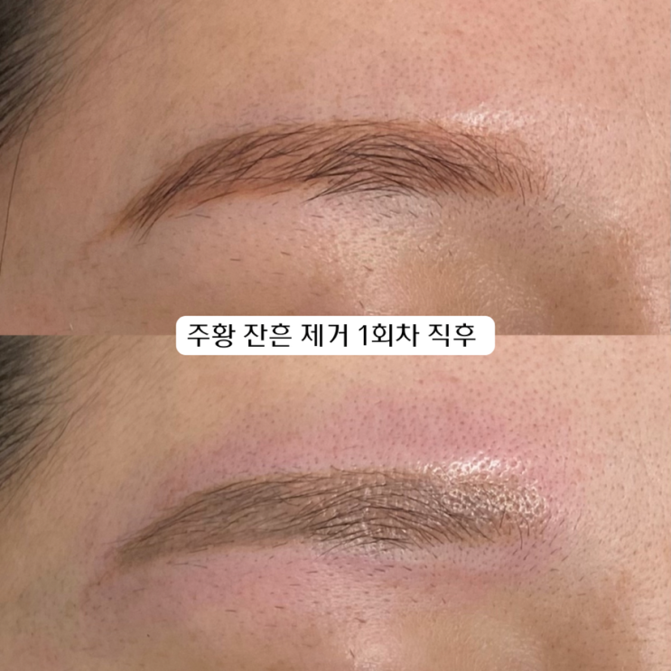 검단일산김포 눈썹문신제거 📌눈썹문신을 지우고 싶어요 잔흔제거 가격 후기 및 정보 반영구색소제거의 원리 네이버 블로그