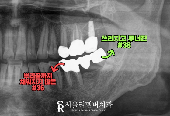 제 기능하지 못하는 오래된 브릿지 보철 제거 후 재신경치료와 임플란트 로 어금니 통증 해결 서울대입구역 치과 네이버 블로그