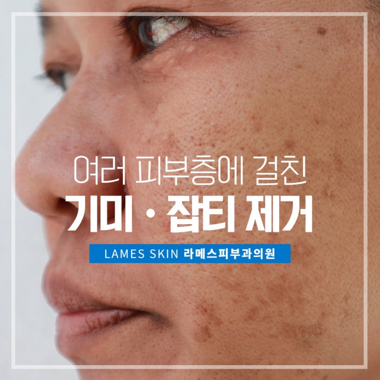 기미 잡티 치료 레이저토닝과 제네시스토닝의 효과 차이강남 논현피부과 네이버 블로그