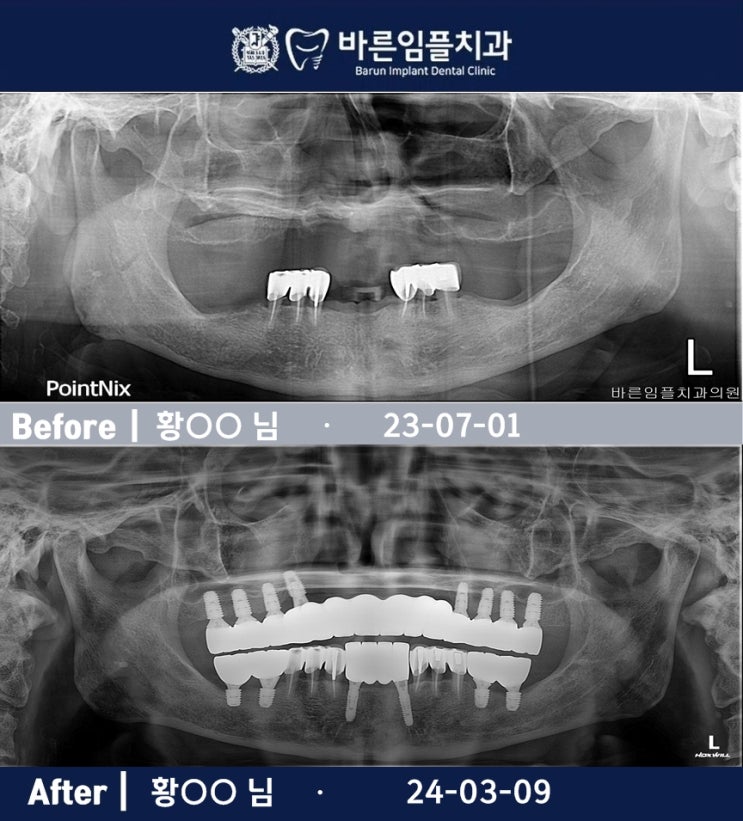 노원치과추천 상악동거상 골유도재생술을 동반한 전체임플란트 수복사례 네이버 블로그