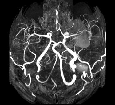24년2월1일_MRA 검사 동의 : 네이버 블로그