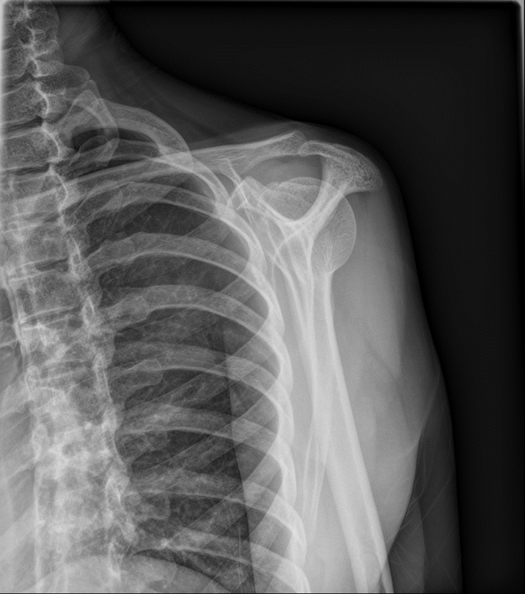아임재근 케이스 스터디 3편 상완골 근위부 견열골절proximal Humerus Avulsion Fracture 회전근개