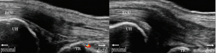 [손목 초음파] 6th compartment_Extensor carpi ulnaris(척측수근신근) : 네이버 블로그