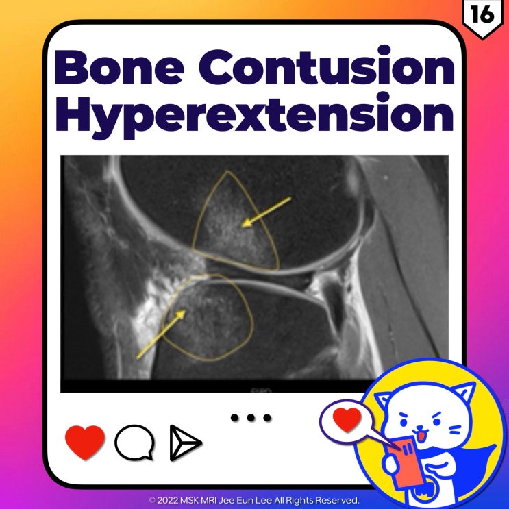(Fig 2-E.16) Bone Contusions In PCL Hyperextension Injury : 네이버 블로그