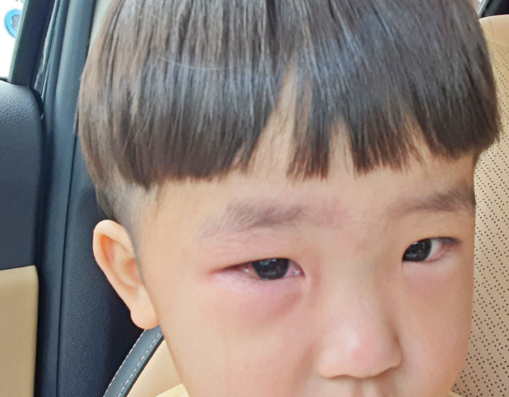 아기 꽃가루 알레르기 증상 유아 알레르기 결막염 증상 및 치료 과정 네이버 블로그