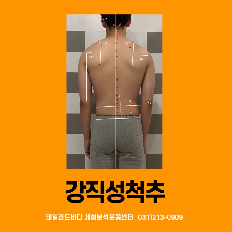 광교체형교정 수원pt 허리와 골반 통증이 좋아지지 않는 군입대를 앞둔 남자라면 강직성 척추염을 의심해 봐야 합니다 1편