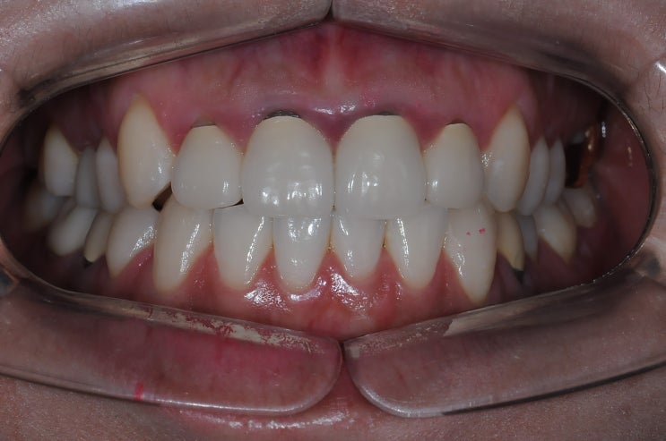 [보철과] 오래된 PFM보철물 PFZ로 교체하기 (procelain fused ziconia crown) : 네이버 블로그