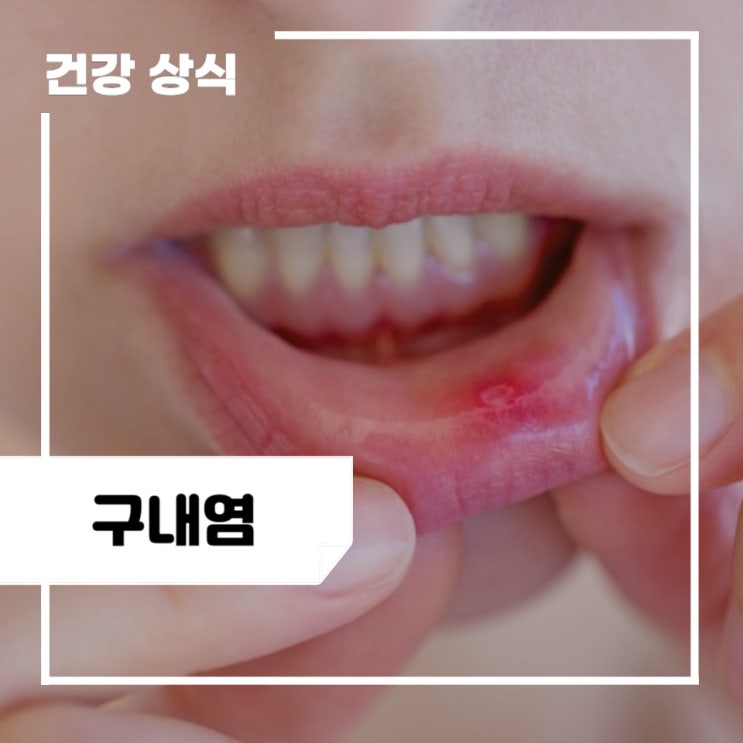 입안 구내염 원인 및 초기 증상 연고 약 전염 유무 아프타성 성인 유아기 어린이 네이버 블로그