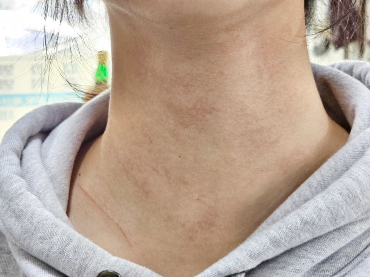 몸에 알레르기 두드러기 원인 콜린성 알레르기 증상 정리 네이버 블로그