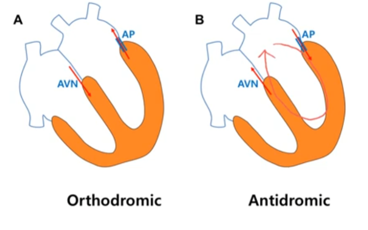 20. 정방향 역방향 방실회귀빈맥 orthodromic antidromic AVRT : 네이버 블로그