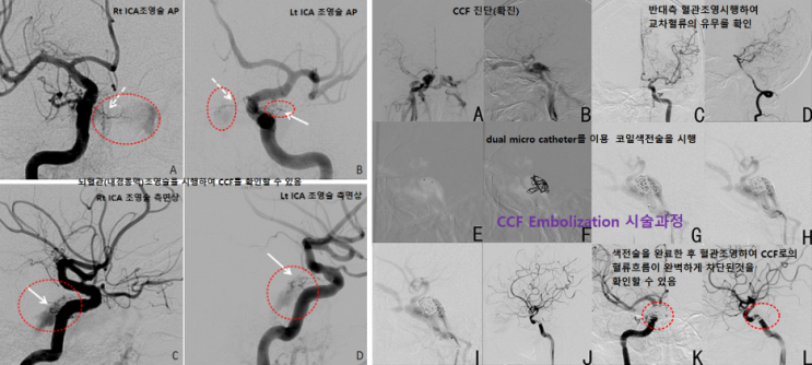 목동맥 해면정맥굴샛길 색전술 (Carotid Cavernous Fistula, CCF Embolization) : 네이버 블로그