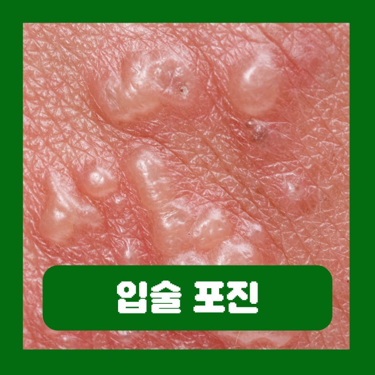 입술 포진 빨리 치료 기간 딱지 원인 입술주변포진 술 네이버 블로그
