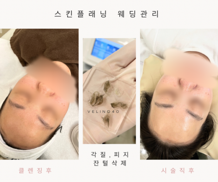 순천피부관리•벨리노40•요즘 신부님들 필수코스관리단 한번에 드라마틱한 효과순천스킨플래닝순천웨딩관리 네이버 블로그