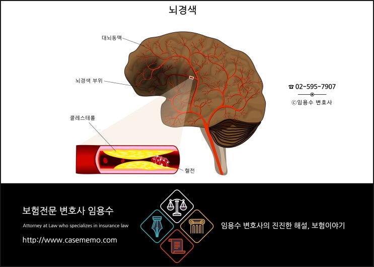 I63.8의 기타 뇌경색증 진단을 받은 경우 뇌졸중 진단 보험금 지급해라 : 네이버 블로그