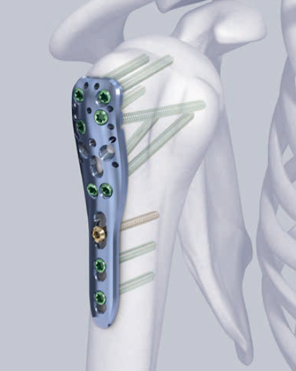 Fx-Shoulder /Proximal humerus Fx. (AO philos plate) : 네이버 블로그