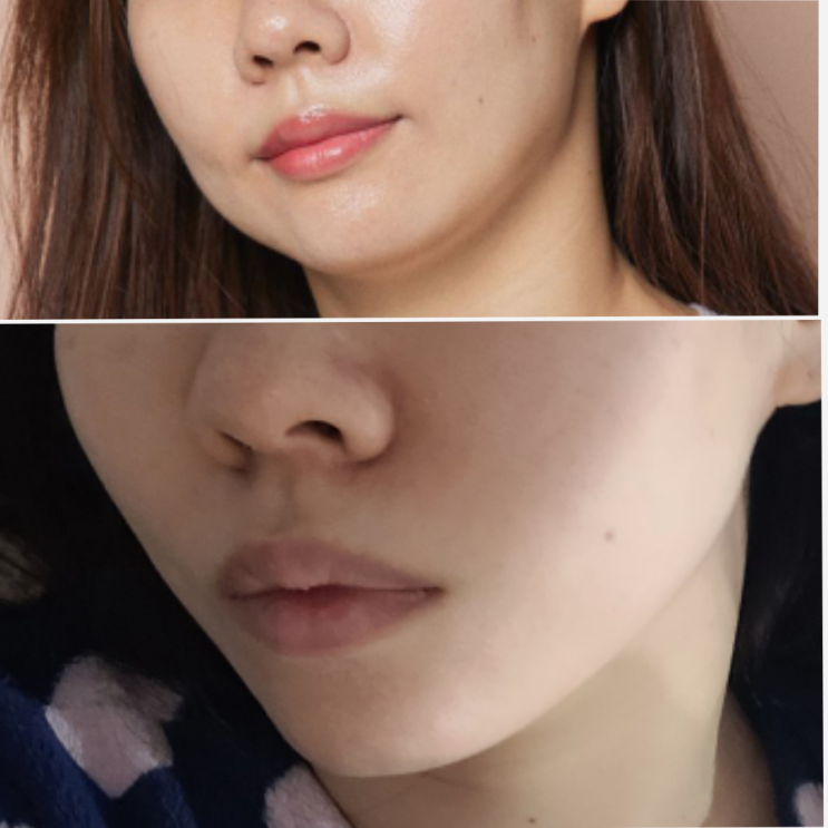 청담동 피부과 소멸핏 광대이중턱 소멸 후기 네이버 블로그