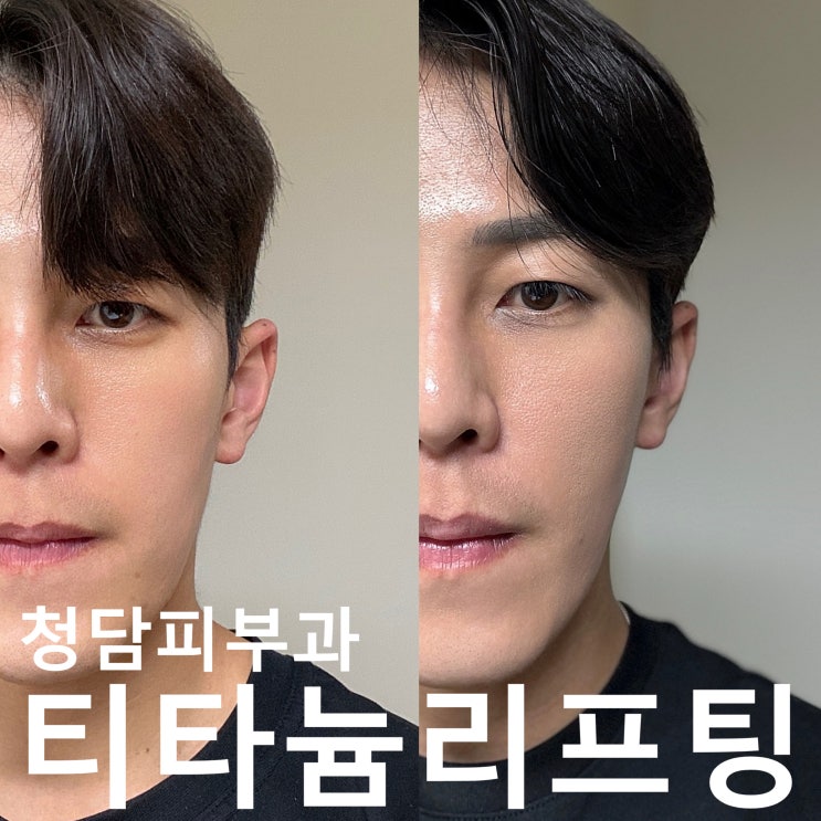 강남 티타늄리프팅 잘하는곳 티타이너 내돈내산 효과 통증 후기 네이버 블로그