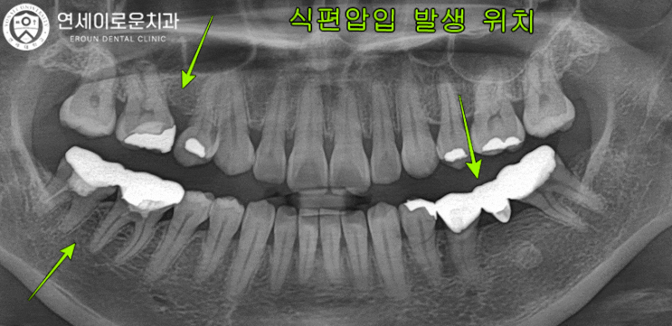 문래동 치과 - 부분 교정 치료 를 동반한 임플란트 수술 후기 (feat. 식편압입 food impaction) : 네이버 블로그