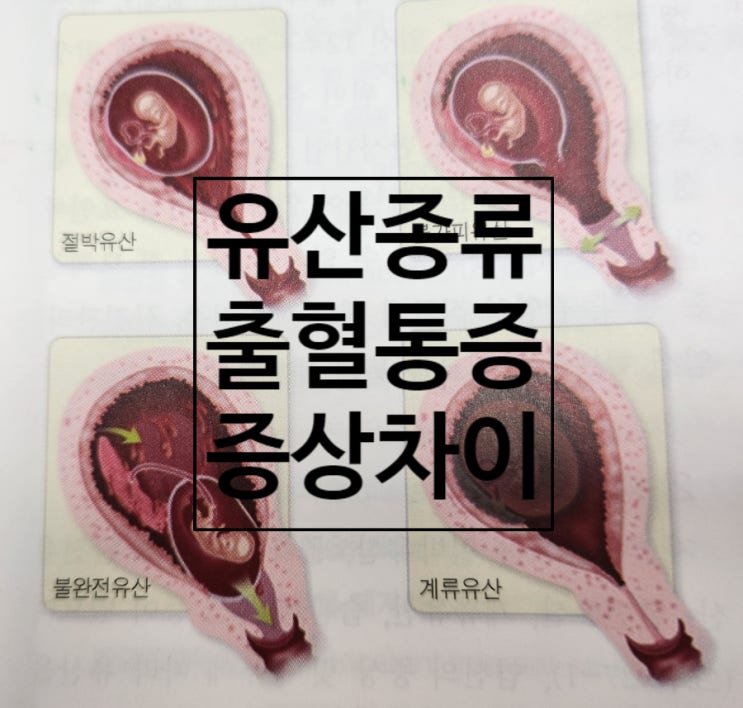 임신초기 자연유산 원인 증상 유산종류 절박유산 불가피유산 불완전유산 계류유산 차이 비교 네이버 블로그