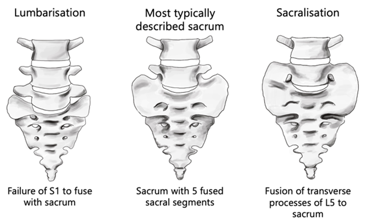 이행성 척추 (LumboSacral Transitional Vertebra, LSTV), 베르톨로티 증후군 (Bertolotti ...