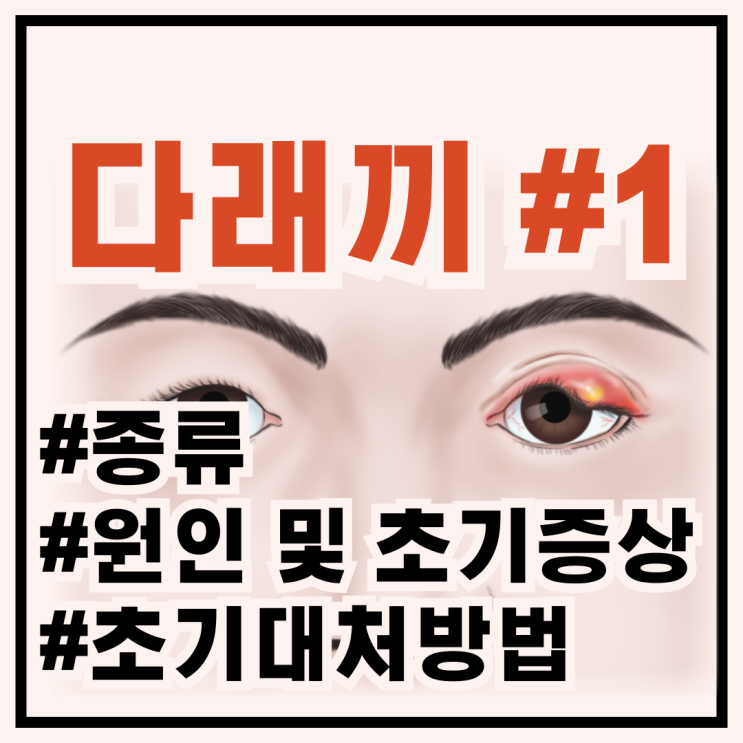 눈다래끼 원인 다래끼 초기증상 및 초기에 빨리 낫는 법 Feat 콩다래끼 전염될까 네이버 블로그