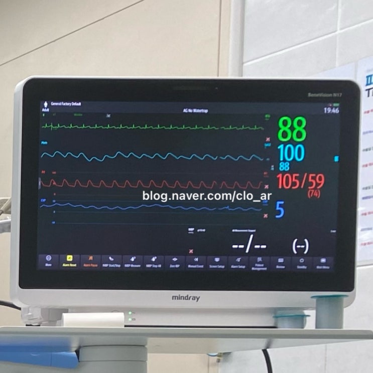 Patient monitoring : BP(sbp, dbp, mbp, nibp, abp, zeroing) : 네이버 블로그